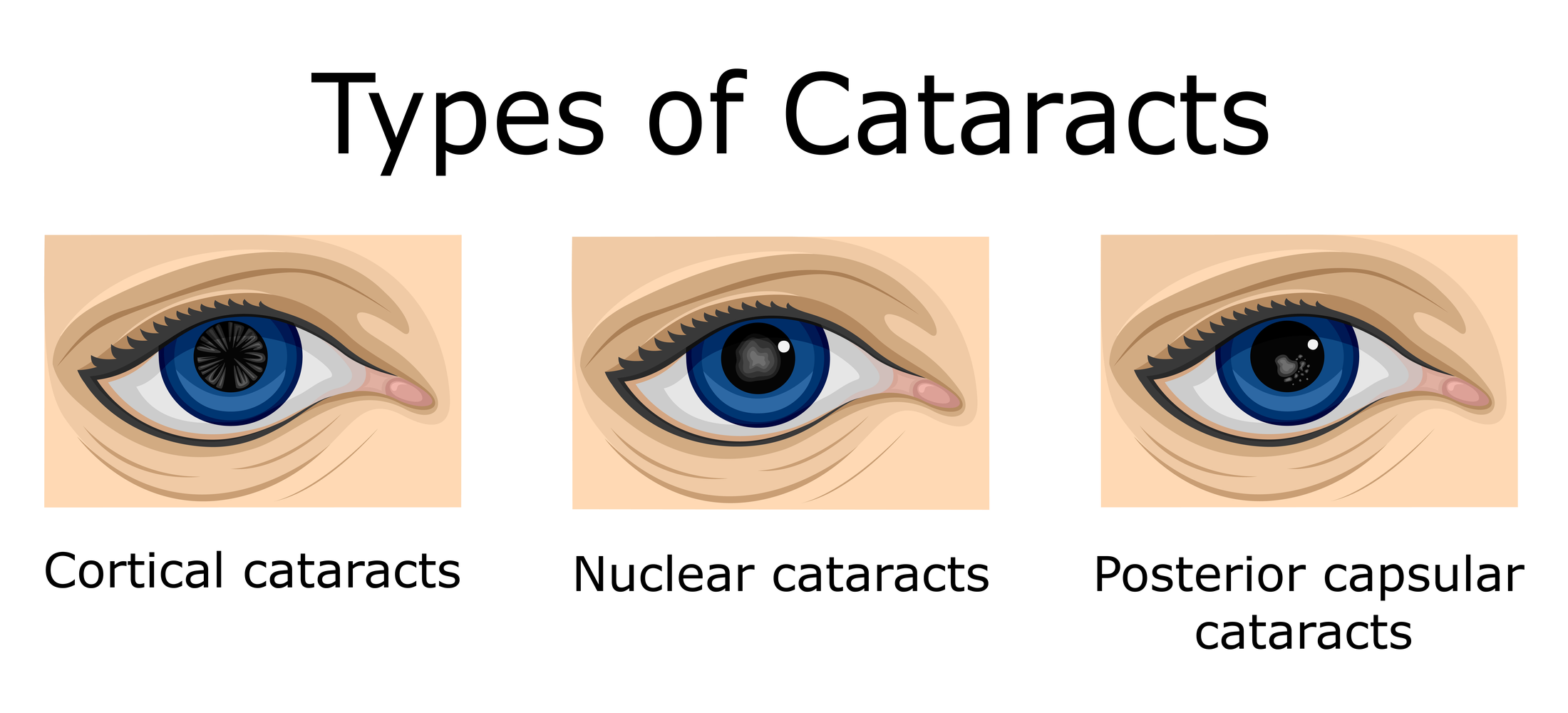 Cataract Surgery @ Om Hospital - EYE & ENT Care Kolhapur